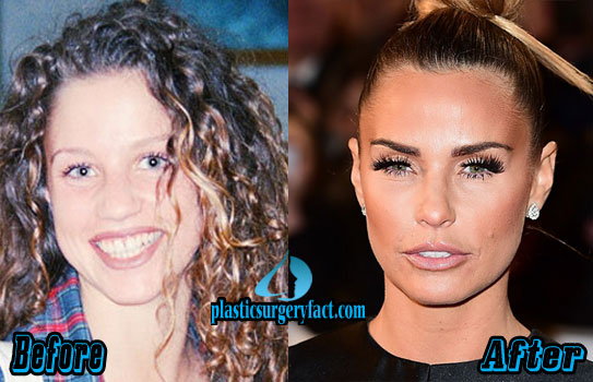 Katie Price Plastic Surgery Katie Price Before And After Veneers Katie Price Plastic Surgery Katie Price Before And After Veneers