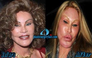 Jocelyn Wildenstein Cat Womanan Plastic Surgery Gone Wrong