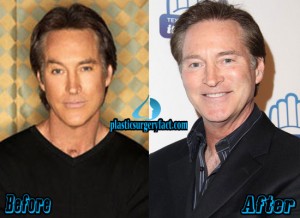 Drake Hogestyn Plastic Surgery Before and After Photos