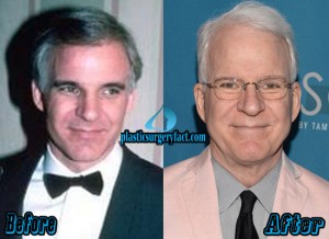 Steve Martin Plastic Surgery Before and After Photos