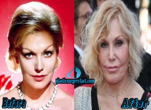 Exclusive Kim Novak Plastic Surgery Reviews by Experts