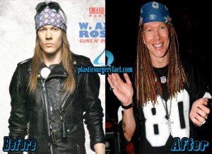Axl Rose Plastic Surgery Before and After Photos
