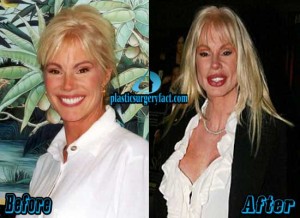 Bree Walker Plastic Surgery Before and After
