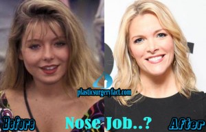 Megyn Kelly Plastic Surgery Before and After