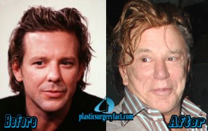 Too Much Plastic Surgery Before and After | Worst Celebrity Plastic Surgery
